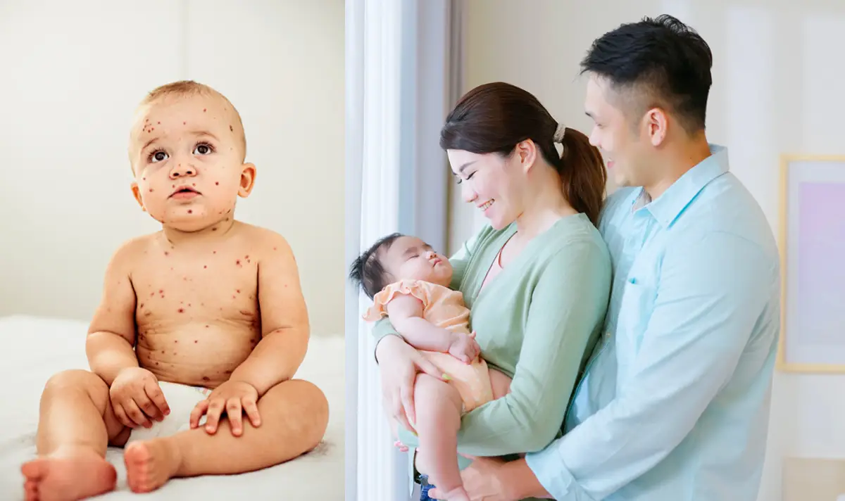 Chicken Pox: What Happens if You Pop a Chickenpox Blister | Pantai ...