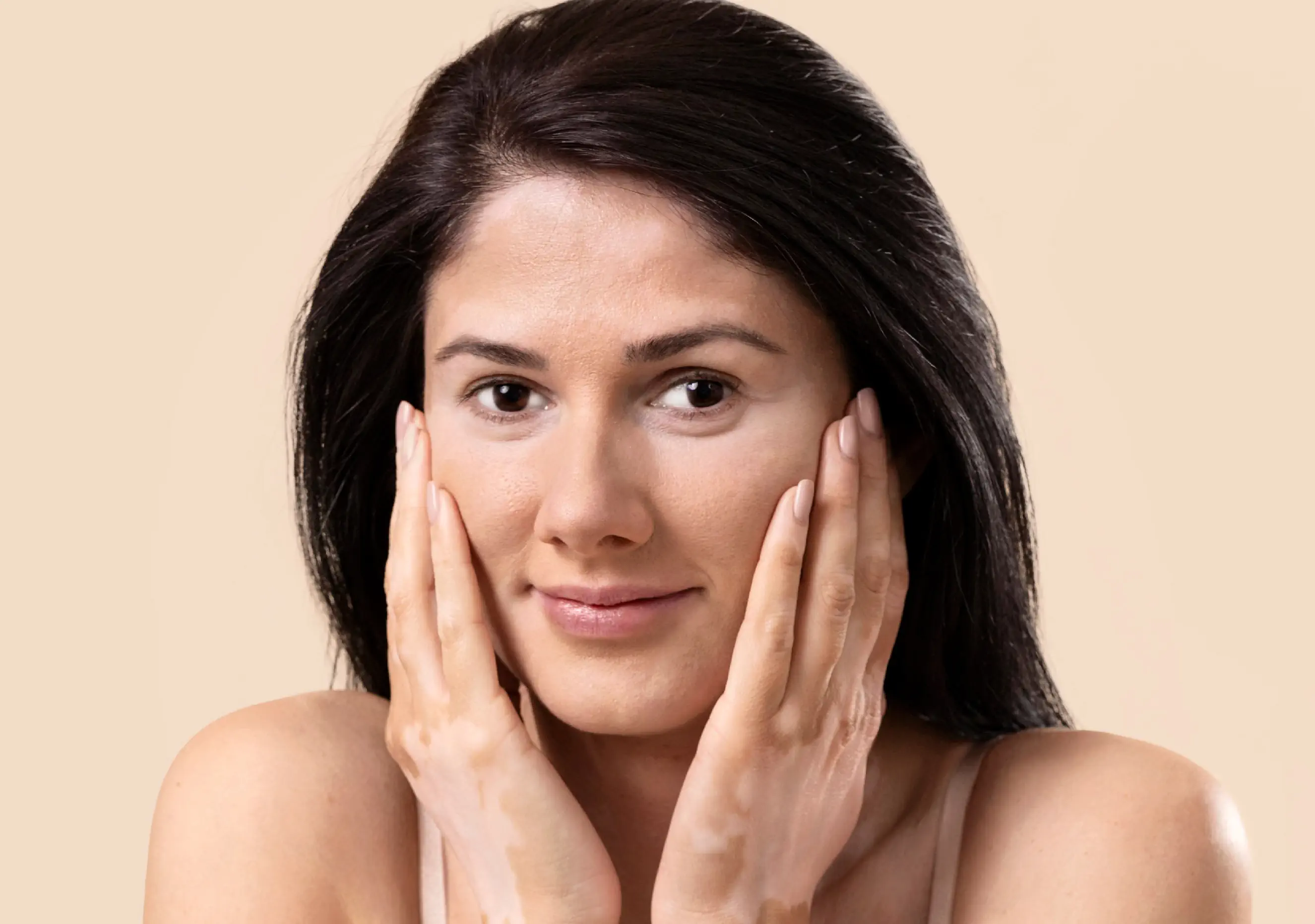 Vitiligo in Malaysia: How to Stop Vitiligo From Spreading?| Pantai ...